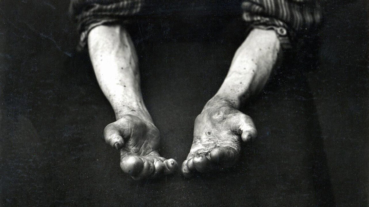 Leprosy case in Romania – first in 40 years | Sweden Herald