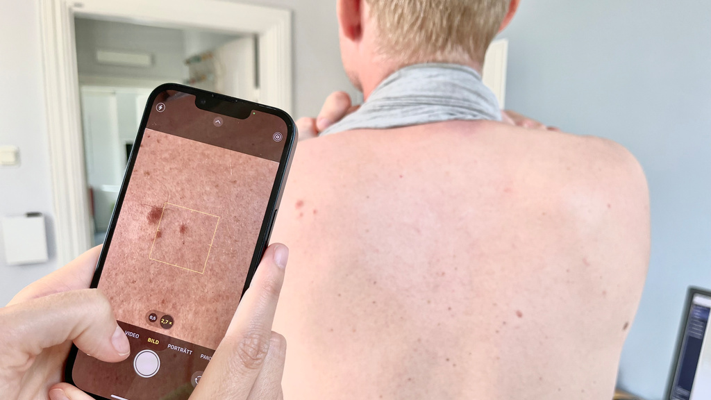 Doctors: Don't trust skin cancer apps | Sweden Herald